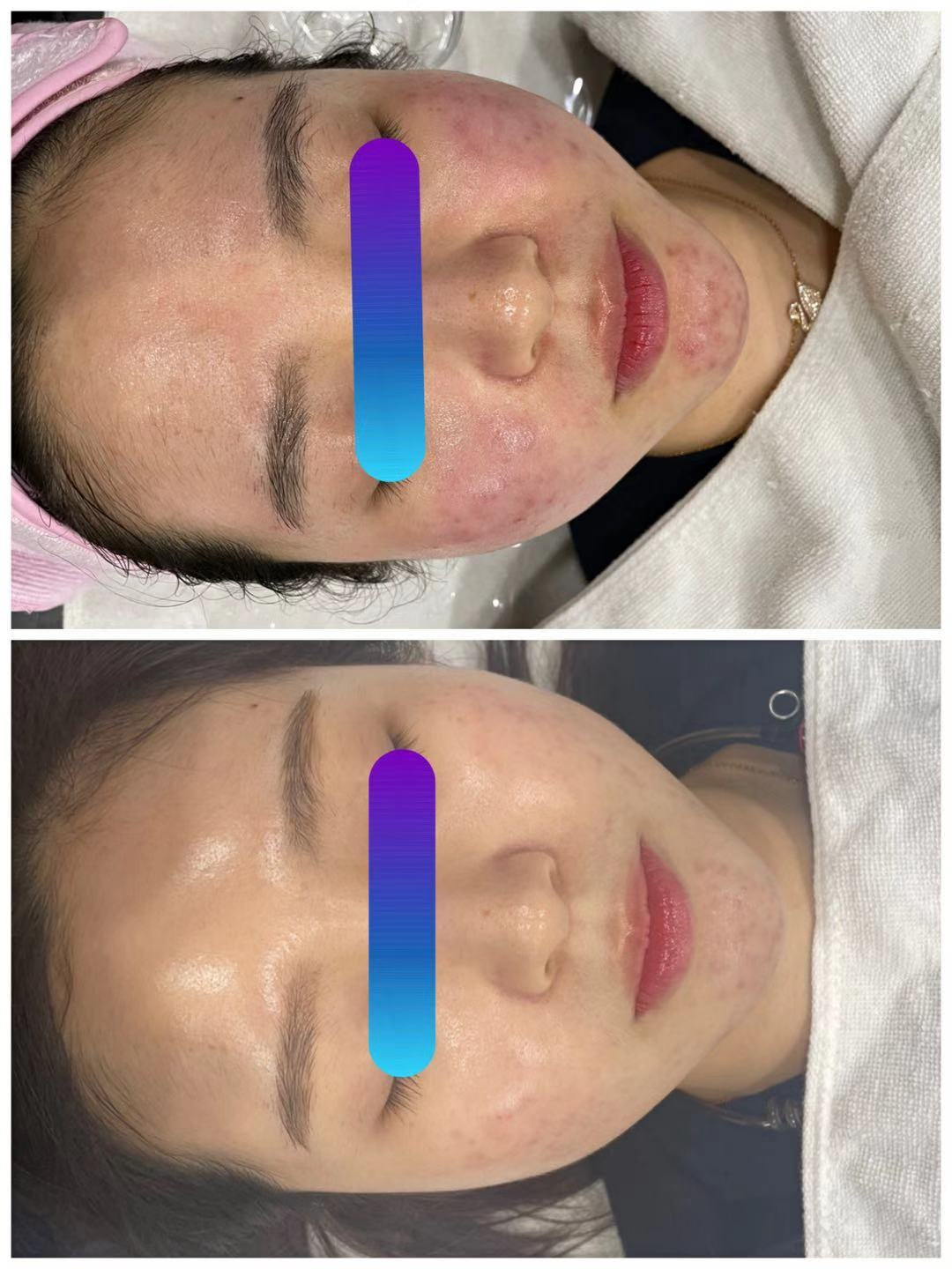 Adverse reaction of bio-microneedling (sponge spicule) treatment ...